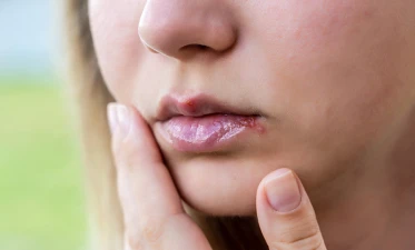 Cheilita angulară | GRAL Medical